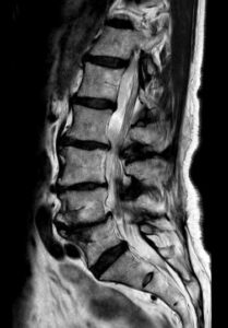 Wirbelsäule: Schmerzen lindern – Orthopäde Dr. Ziolko in Köln